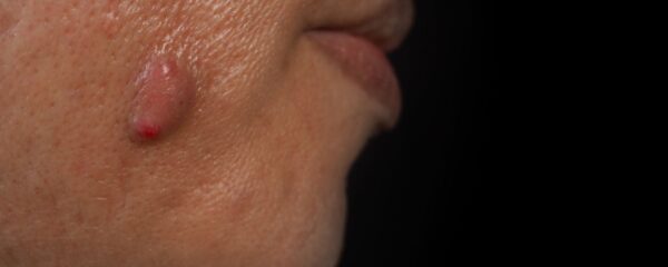 Furunkel und Karbunkel - Symptome, Auslöser und Behandlung