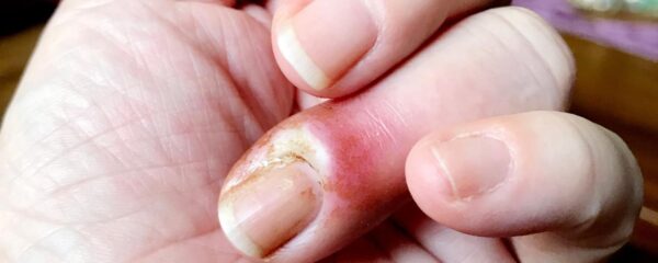 Nagelbettentzündung - Zum Hautarzt mit einem Panaritium?