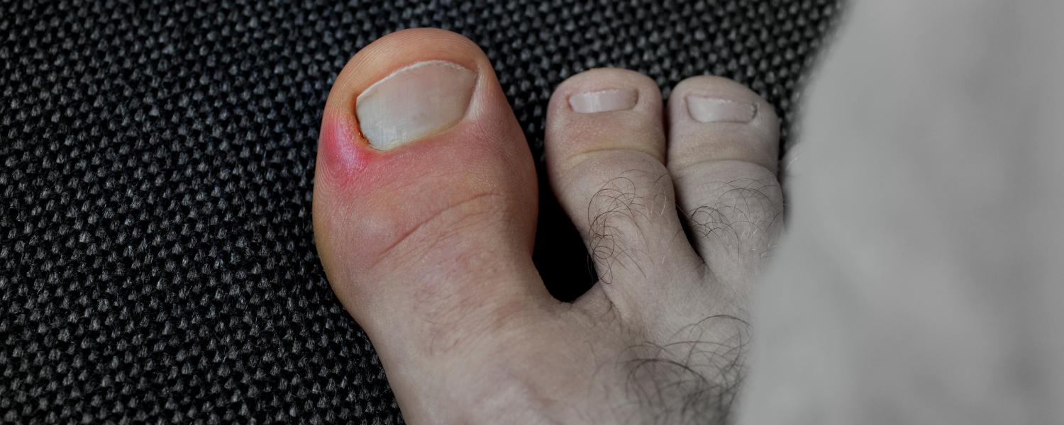 Nagelbettentzündung - Zum Hautarzt mit einem Panaritium?