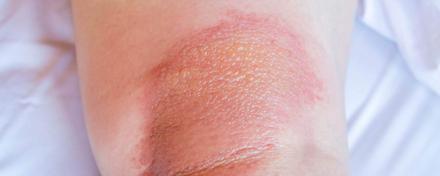 Intertriginöses Ekzem - Symptome + Behandlung vom Hautwolf