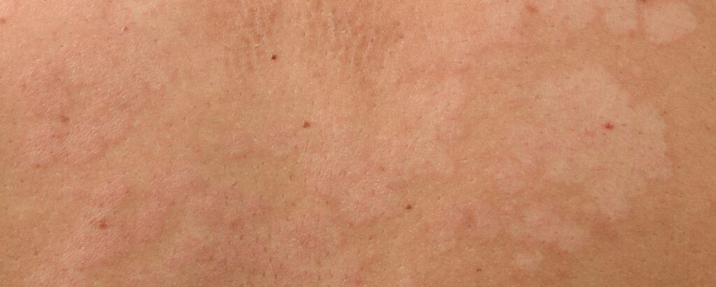 Hautpilz - Alles über Vorkommen, Auslöser und Behandlung