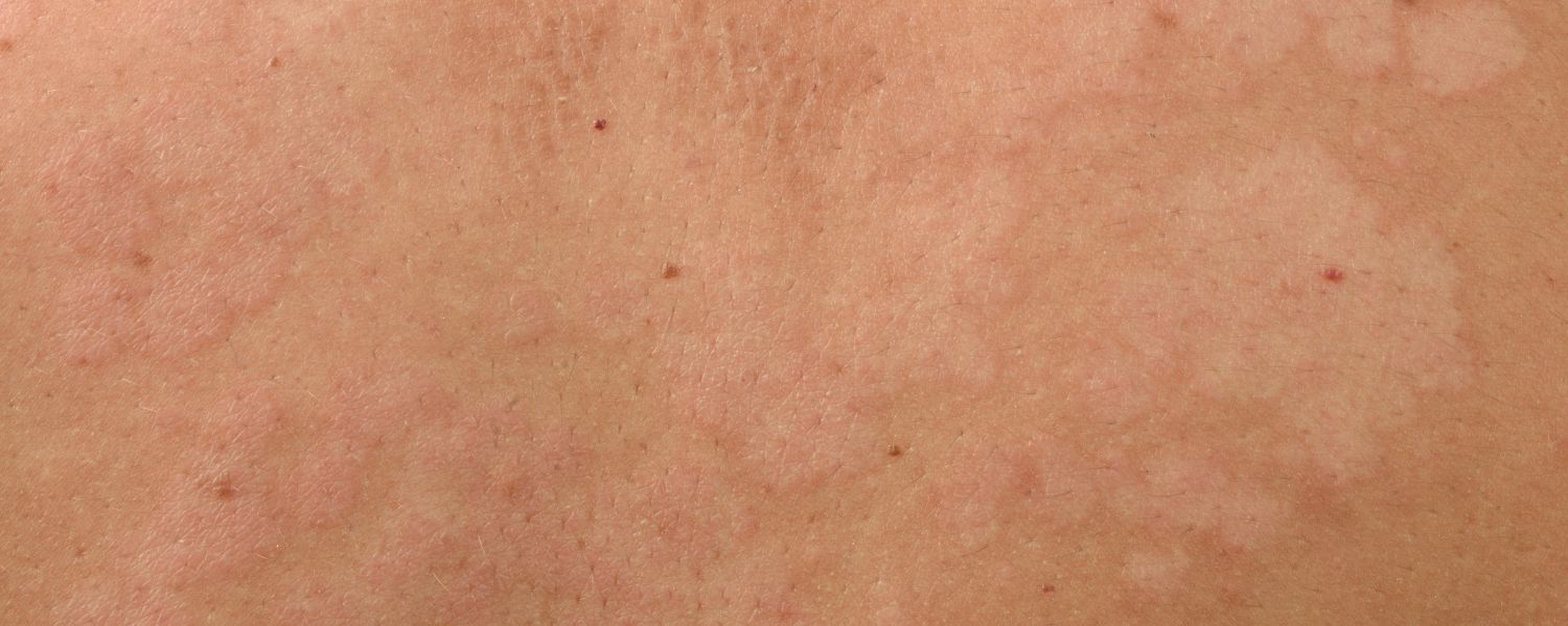 Hautpilz - Alles über Vorkommen, Auslöser und Behandlung