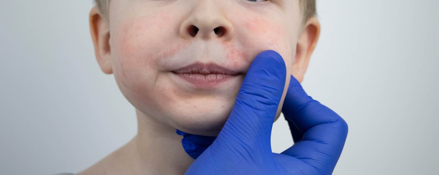 Mundrose - Alles über Symptome, Auslöser und Therapie