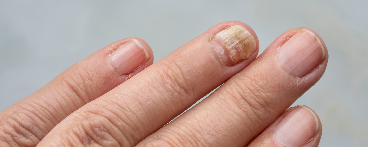 Verwunderlich Nagelpilz Bilder Finger Bild