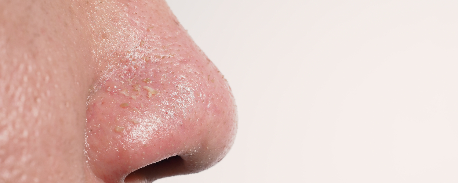 Pickel - Alles über Vorkommen, Auslöser und Behandlung