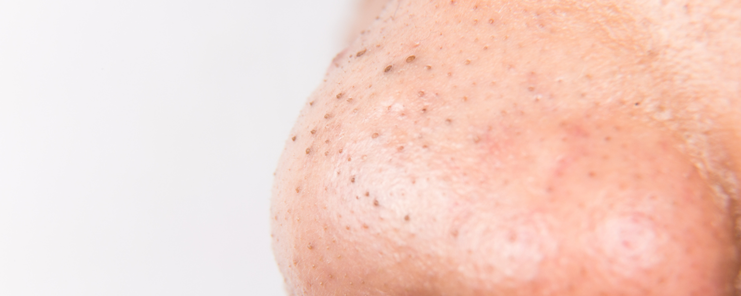 Pickel - Alles über Vorkommen, Auslöser und Behandlung