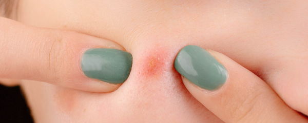 Pickel - Alles über Vorkommen, Auslöser und Behandlung