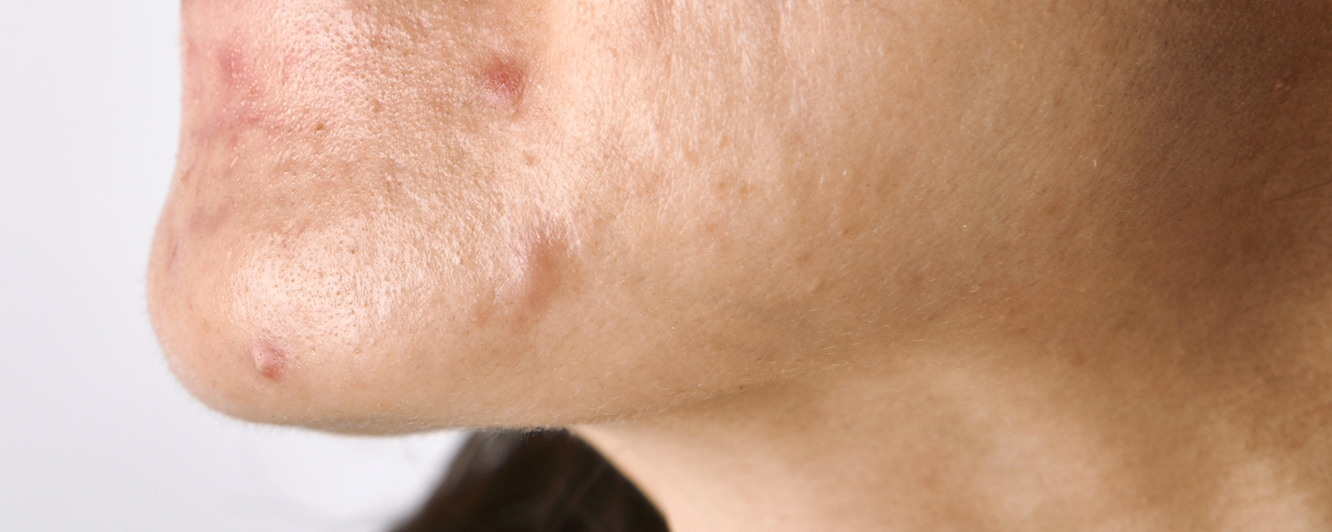 Pickel - Alles über Vorkommen, Auslöser und Behandlung