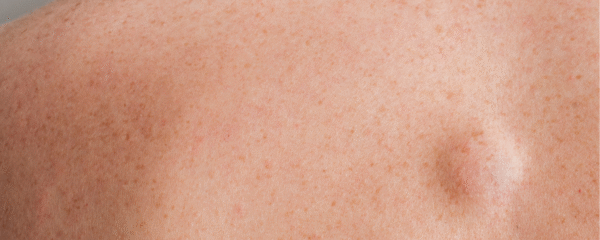 Lipom - Alles über Symptome, Ursachen und Behandlung