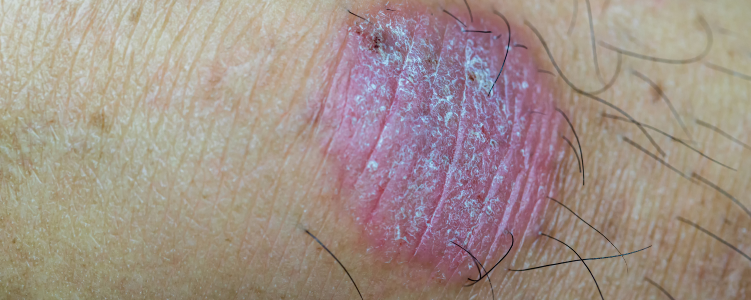 Tinea barbae und Tinea capitis - Ursachen und Behandlung
