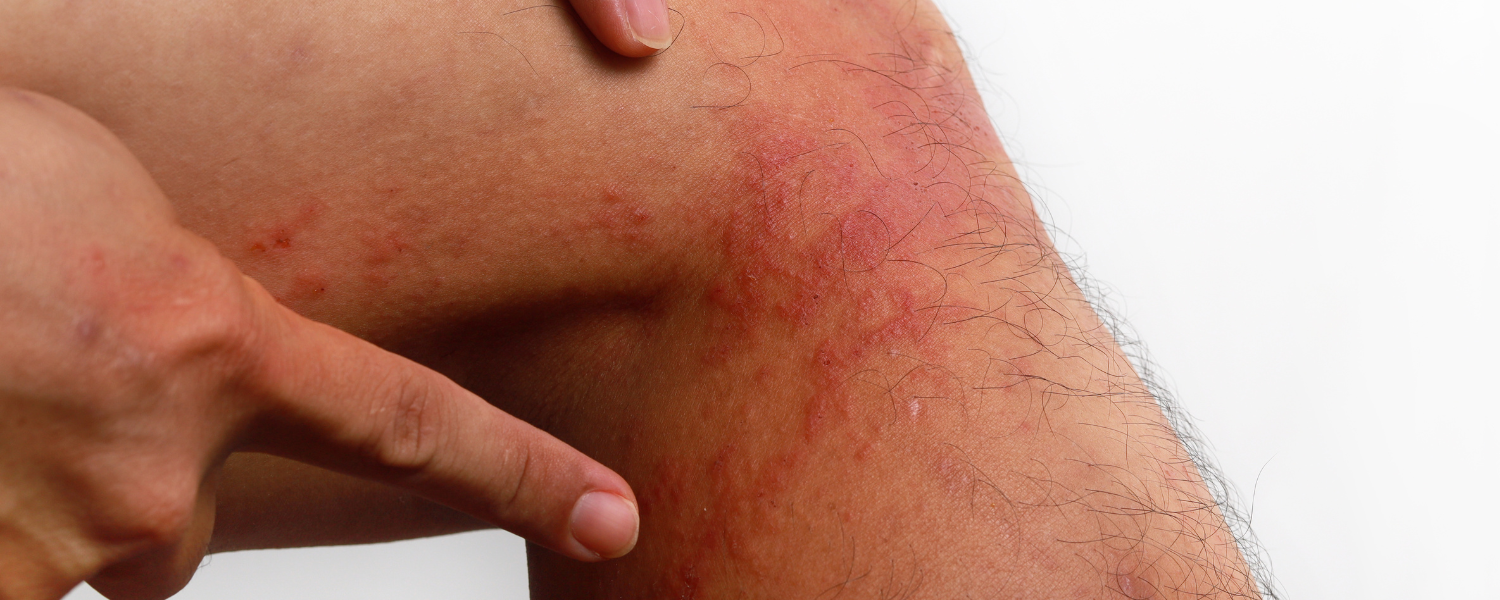 Lichen simplex chronicus - Symptome, Auslöser und Behandlung