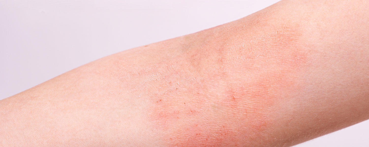 Lichenifikation - Symptome, Auslöser und Behandlung